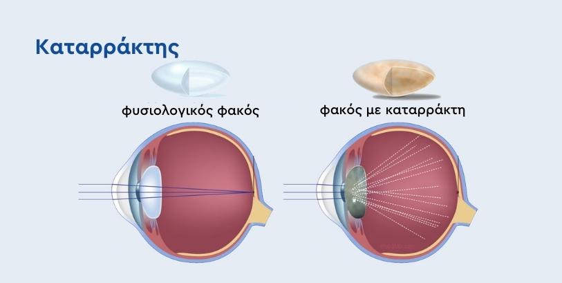 Καταρράκτης – Μυρσίνη Κ. Πετρέλλη